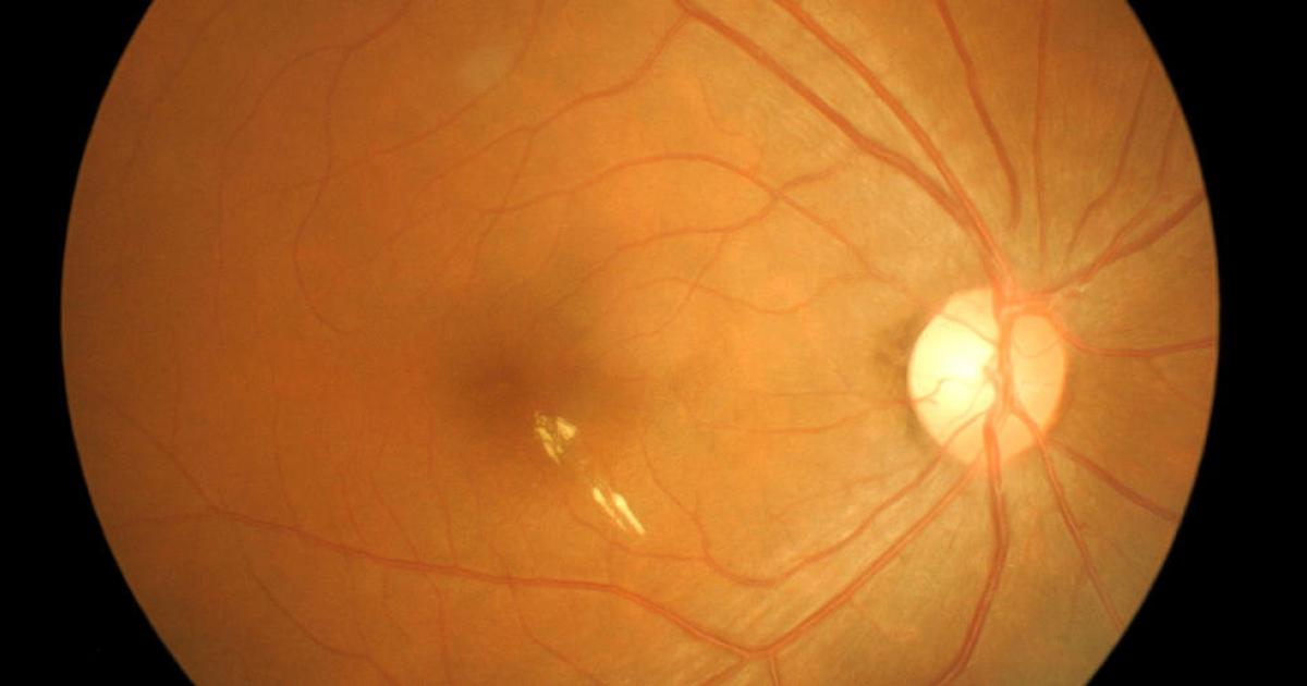 Proliferative Diabetic Retinopathy Neovascularization