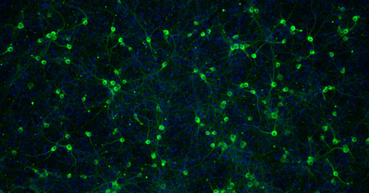 microRNAs in neurodegeneration | University of Helsinki
