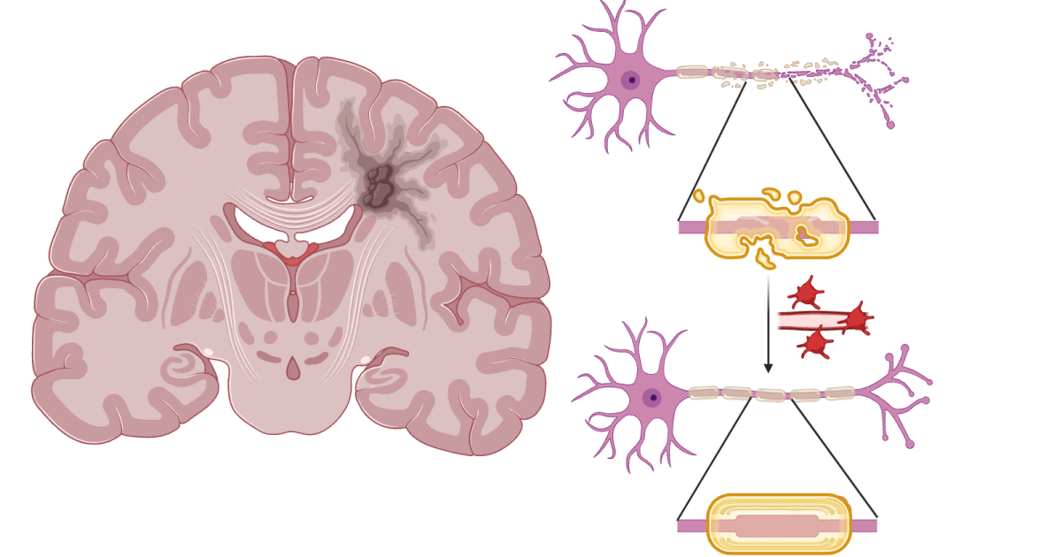 Myelin Regeneration in Multiple Sclerosis: Re-covering the Bare Wires ...
